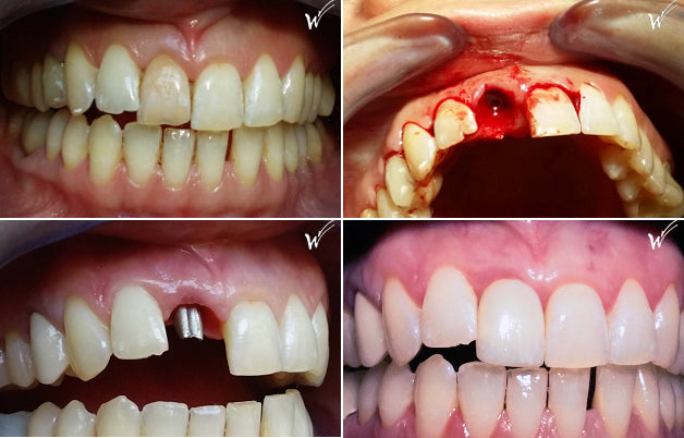 Comment remplacer une dent qui n'a plus de Racine ? – Dentetica
